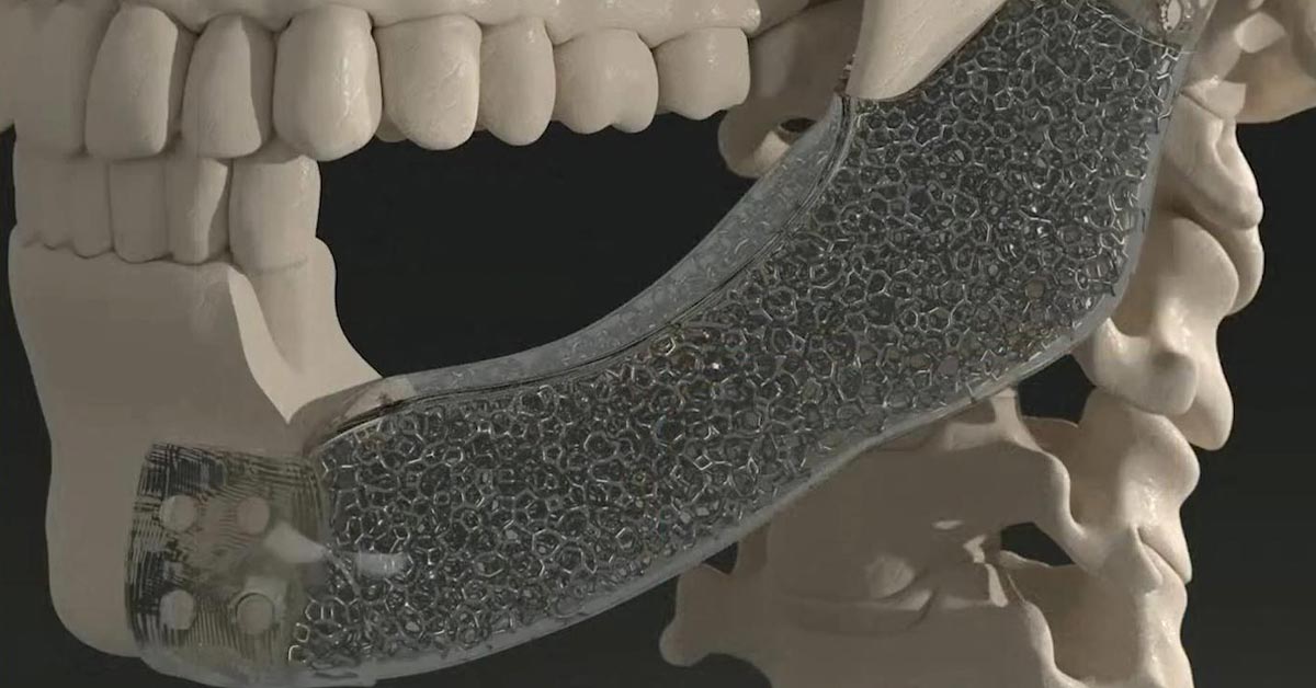 Revolutionize Medical Device and Implant Design with Implicit Modeling